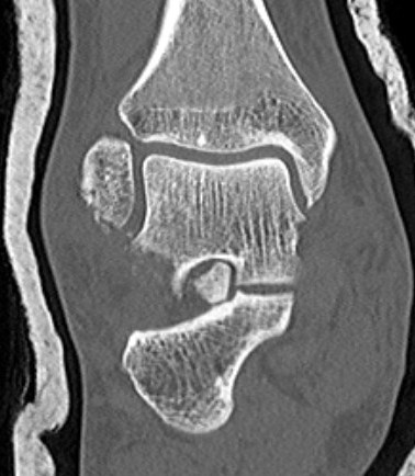 Subtalar Dislocation | The Bone School